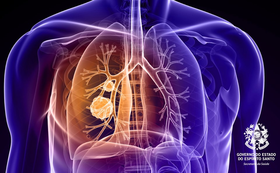 Governo ES - Saiba mais sobre fibrose cística, a doença do beijo salgado